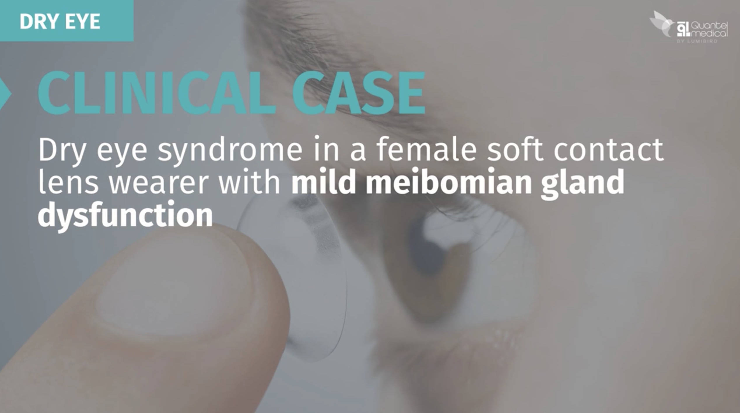 Mild Meibomian Gland Dysfunction